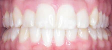Before and After Smile Gallery - Smarter Orthodontics