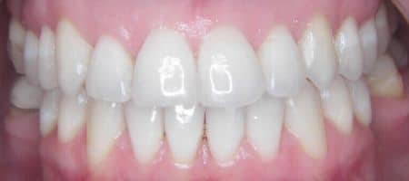 Before and After Smile Gallery - Smarter Orthodontics
